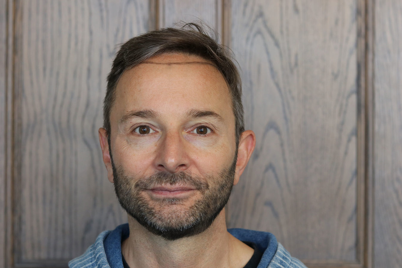 Jeremy Langmead on why more men should try a hair transplant